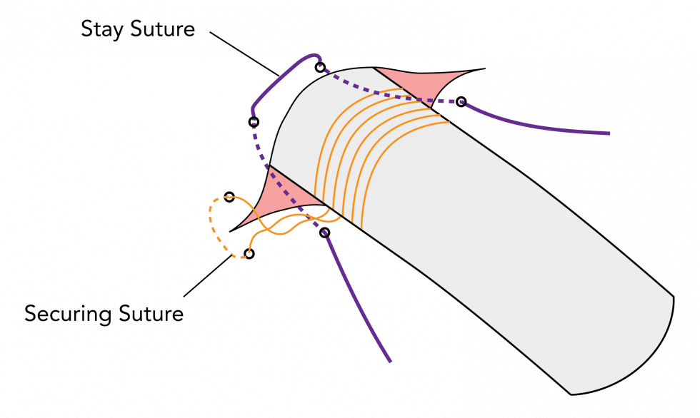 Chest Drain Insertion & Management - theguidewire